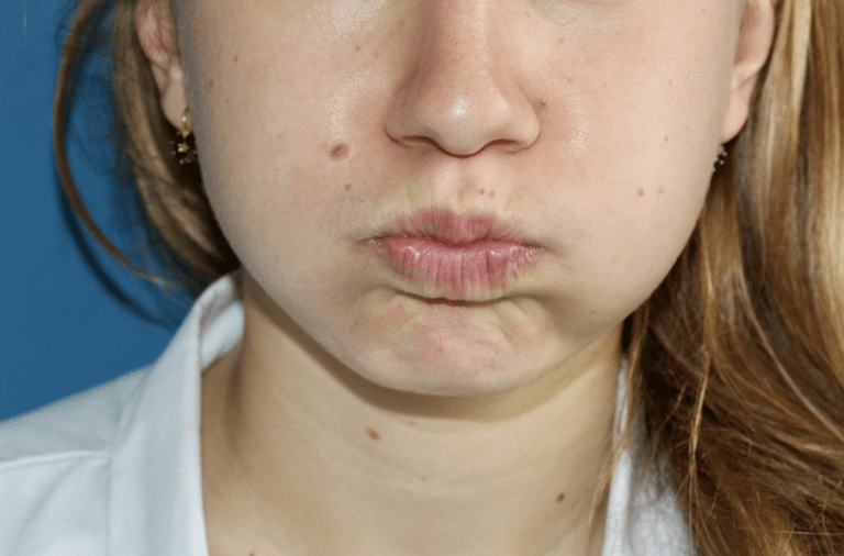 Exercice 14 - Rééducation linguale